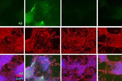 Green Tea and Resveratrol Reduce Alzheimer’s Brain Plaques in Lab Tests ...