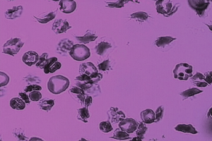 New Research Shows How Sickled Red Blood Cells Clump Together