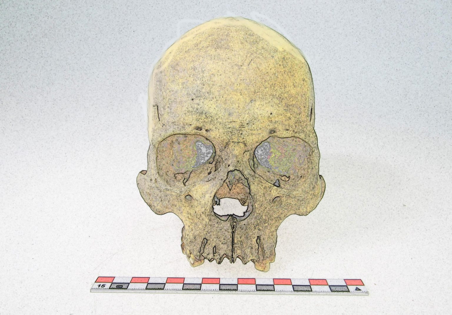 Before Columbus: A 4,000-Year-Old Skeleton Reveals a Rare Leprosy ...