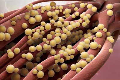 The Missing Link in Public Health: Why We Still Lack a Staph Vaccine