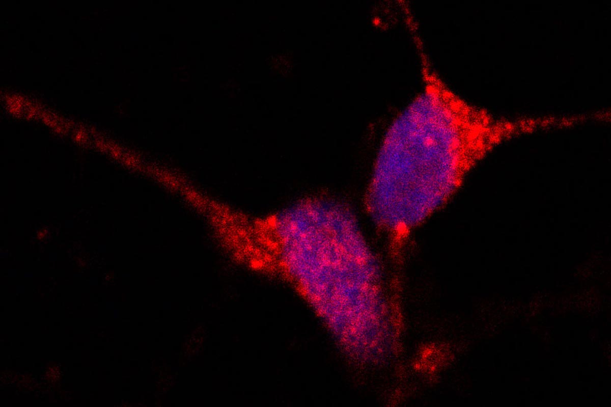 Decoding Tau: The Protein Puzzle in Alzheimer’s Disease