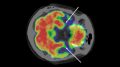 Stressed Brain Linked to “Broken Heart” Syndrome
