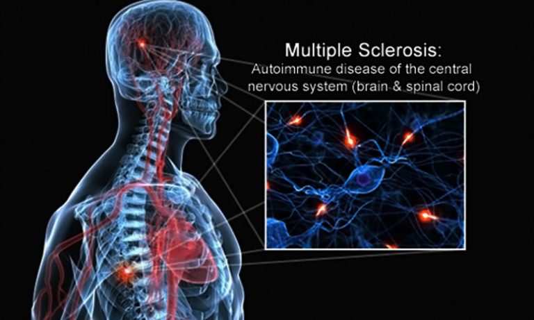 Age and Gut Bacteria Contribute to MS Disease Progression