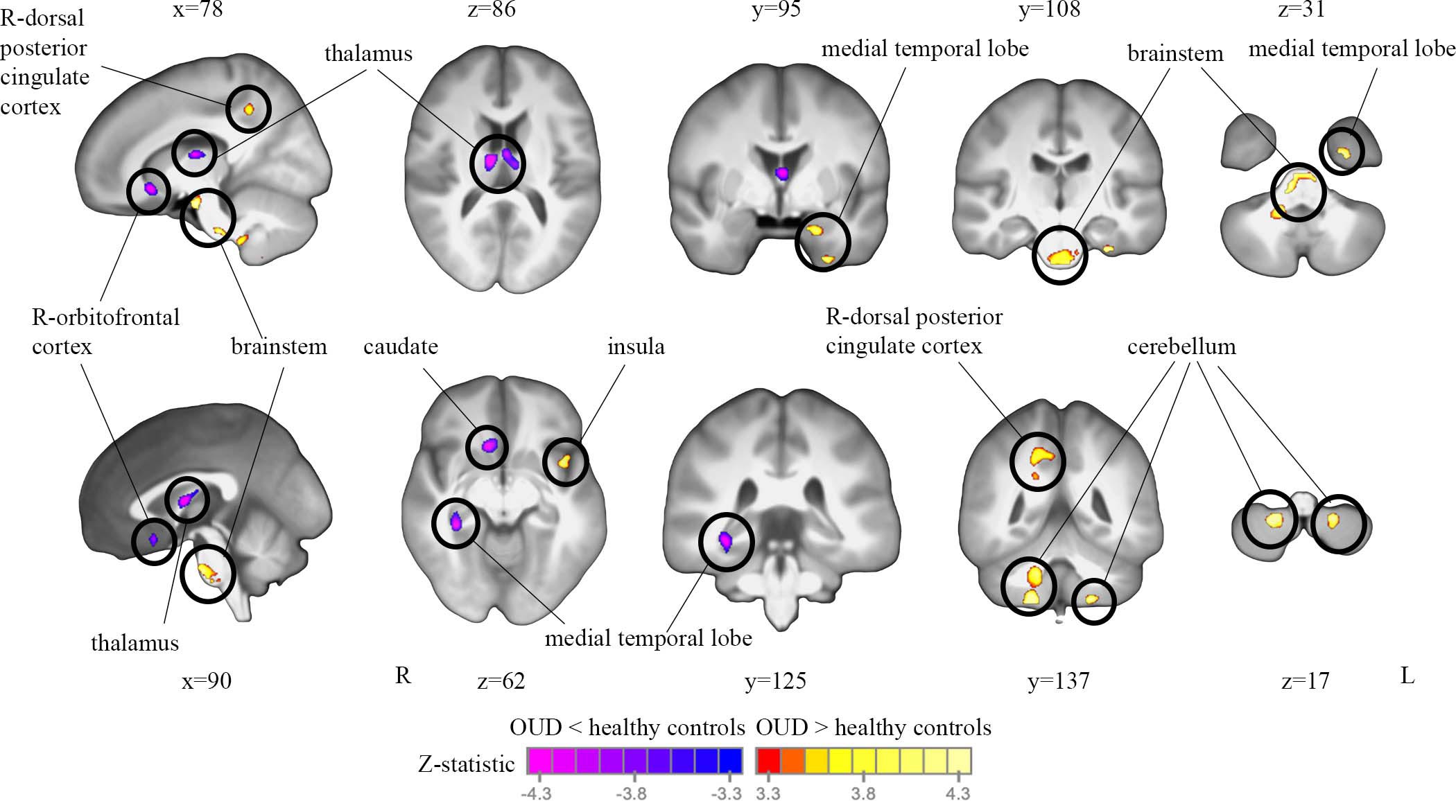 Yale Study Finds Opioids Shrink Key Brain Areas, Expand Others