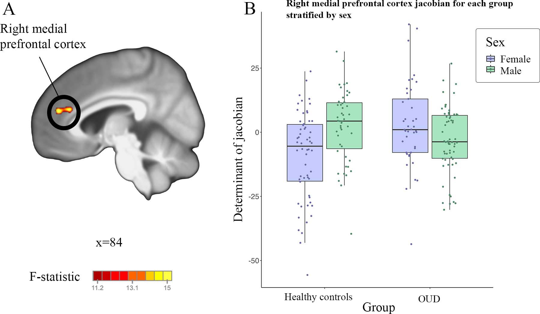 Yale Study Finds Opioids Shrink Key Brain Areas, Expand Others