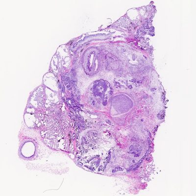 New Insights Into Human Development From “Monster Tumors”