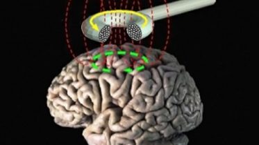 New Study Finds That Deep Brain Stimulation Is Highly Effective in ...