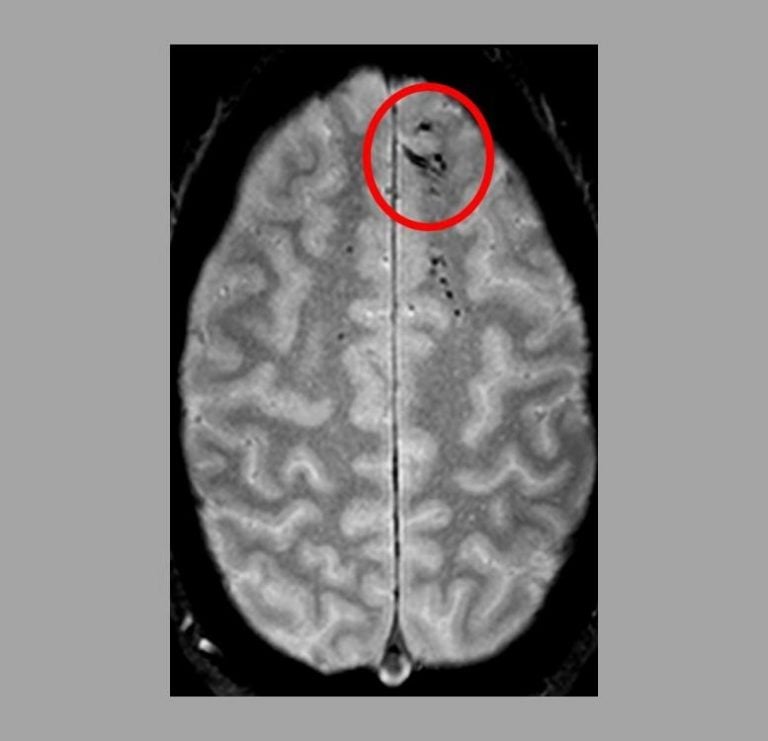 Microbleeds – Too Small to Be Detected on CT Scans – May Worsen Outcome ...