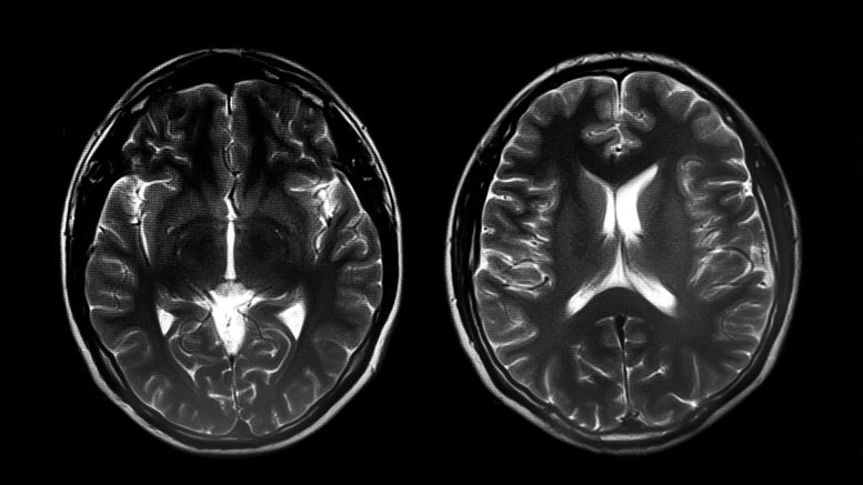 Gene Mutation Linked to Autism Found to Overstimulate Brain Cells