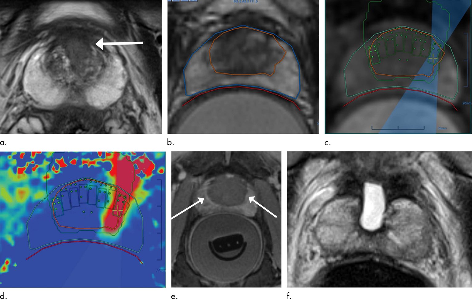 High-Intensity Focused Ultrasound Treats Prostate Cancer With Minimal ...