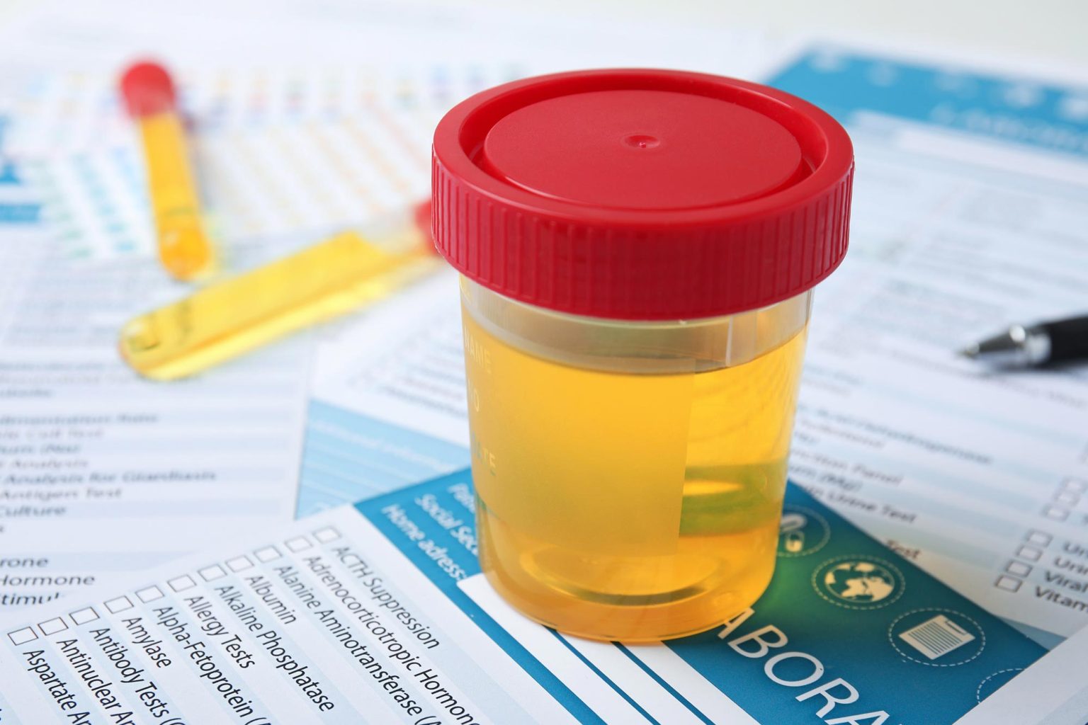 Simple Urine Test Could Revolutionize Bladder Cancer Diagnosis and ...