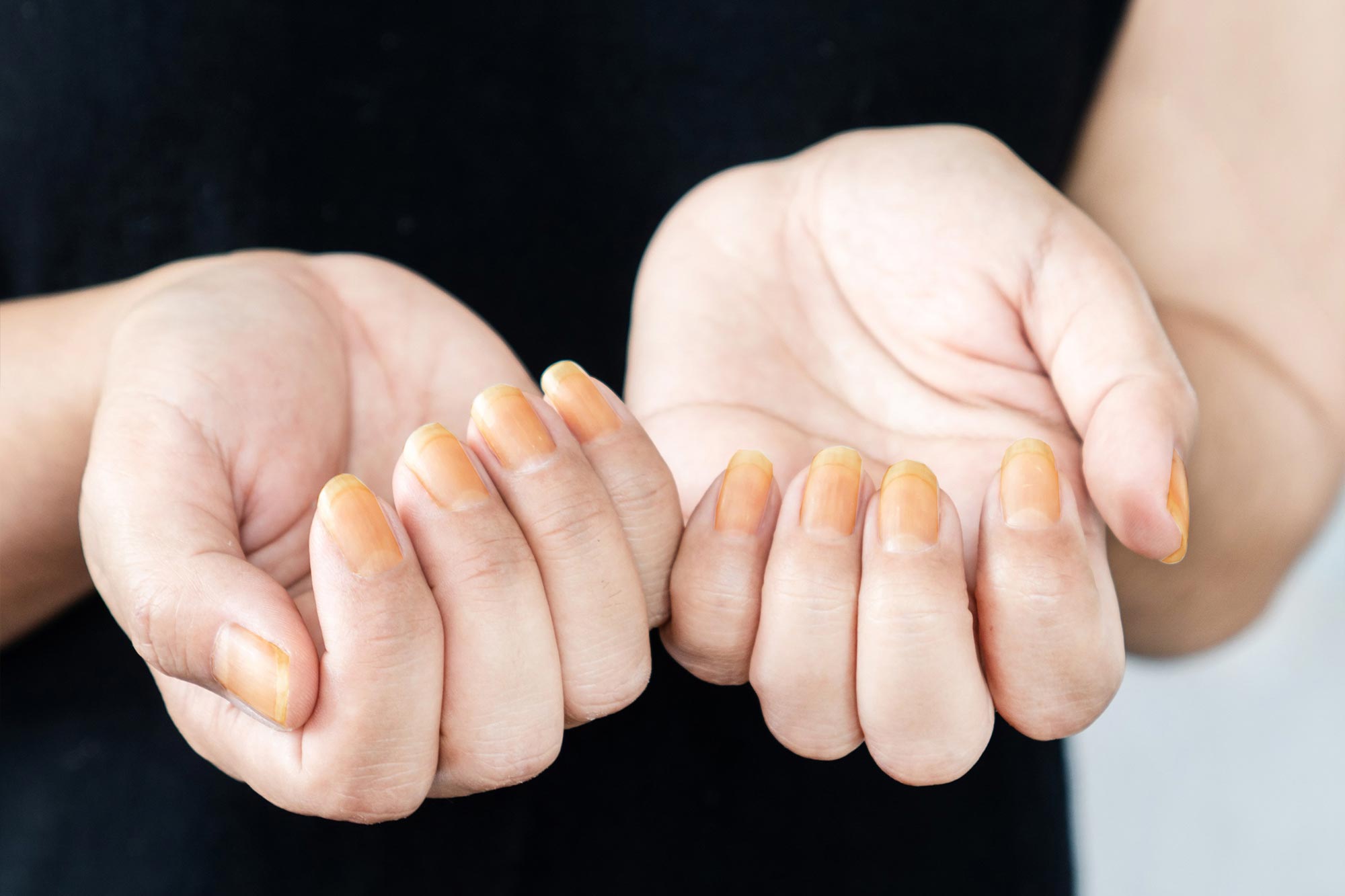 Yellow Nail Syndrome Linked to Defects in Planar Cell Polarity Pathway ...