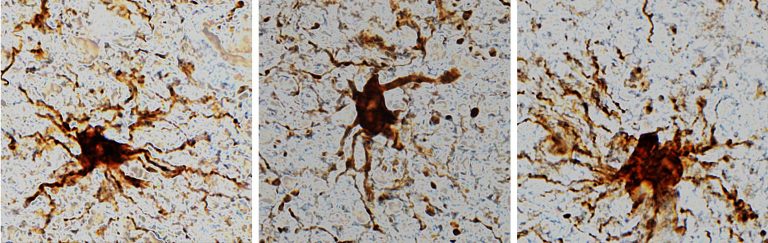 “Zombie” Cells? Research Shows Some Genes Come to Life in the Brain ...