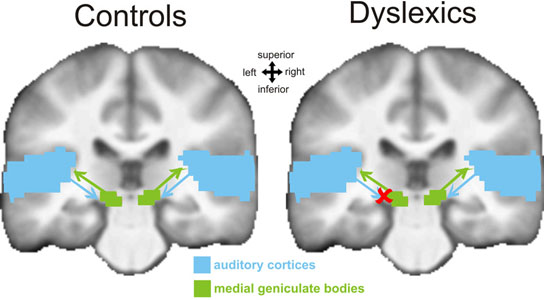 A Step Forward In Understanding The Cause Of Dyslexia A Step Forward In Understanding The Cause Of Dyslexia