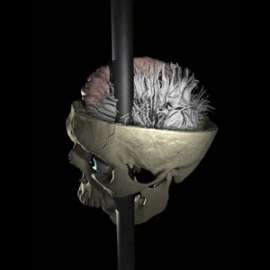 New Research Reveals Damaged Connections in Phineas Gage's Brain